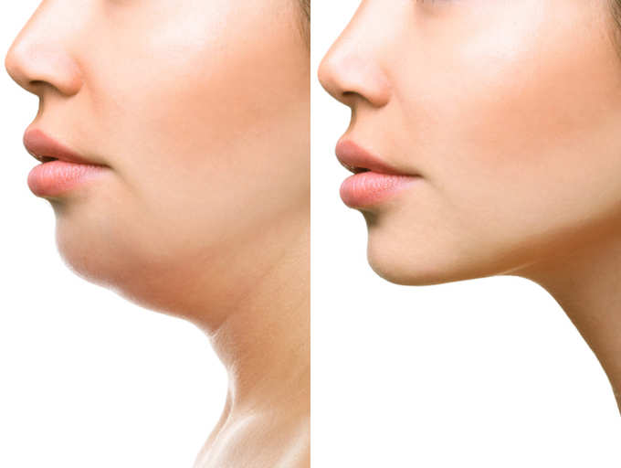 How To Get Rid Of A Double Chin And Neck Fat Naturally Without Surgery